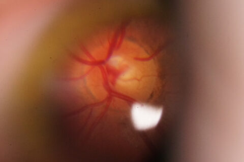 Fundoscopy - Arclight Project